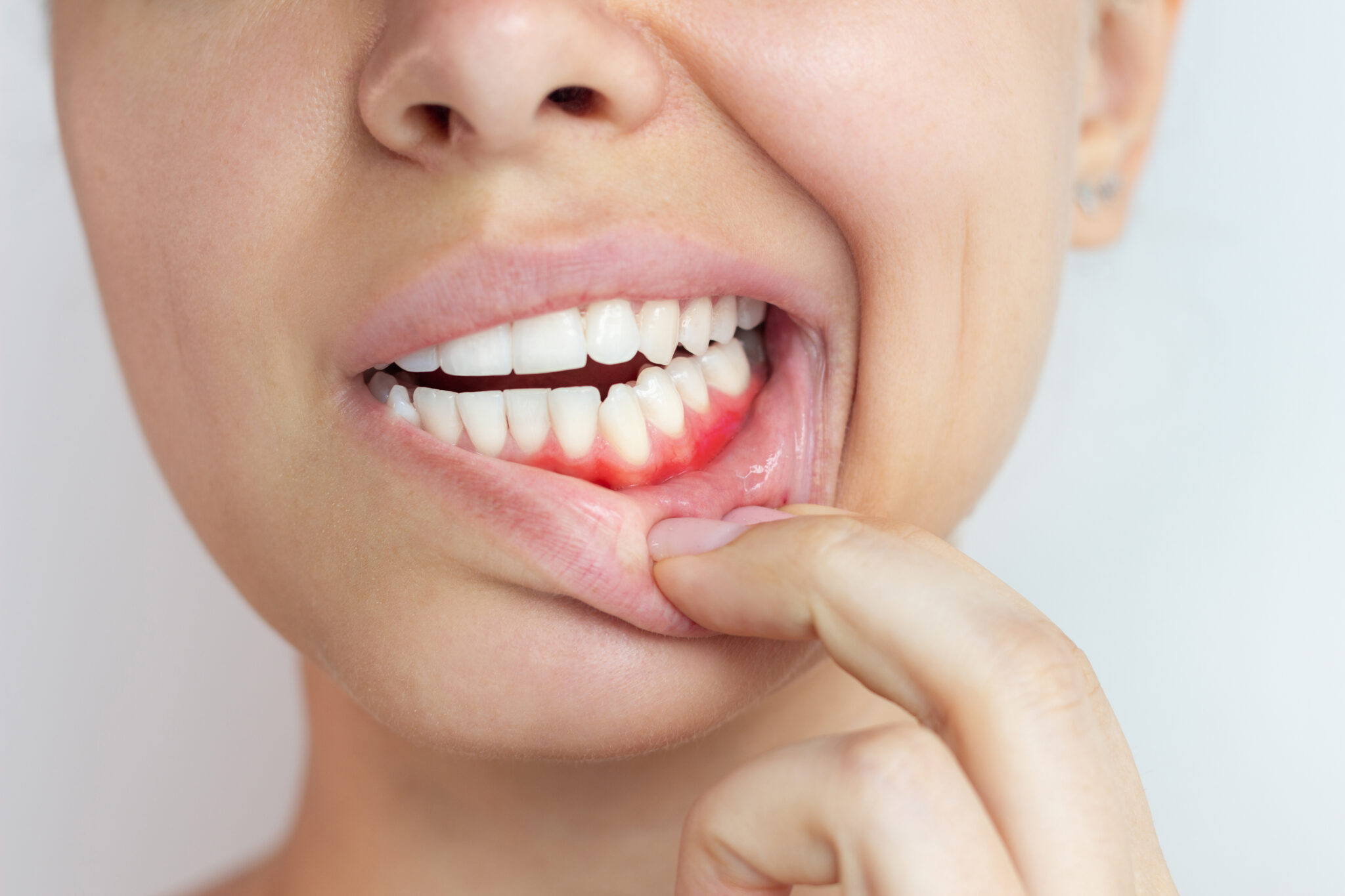 Understanding Gum Diseases: Symptoms, Causes, Diagnosis, Treatment, and ...